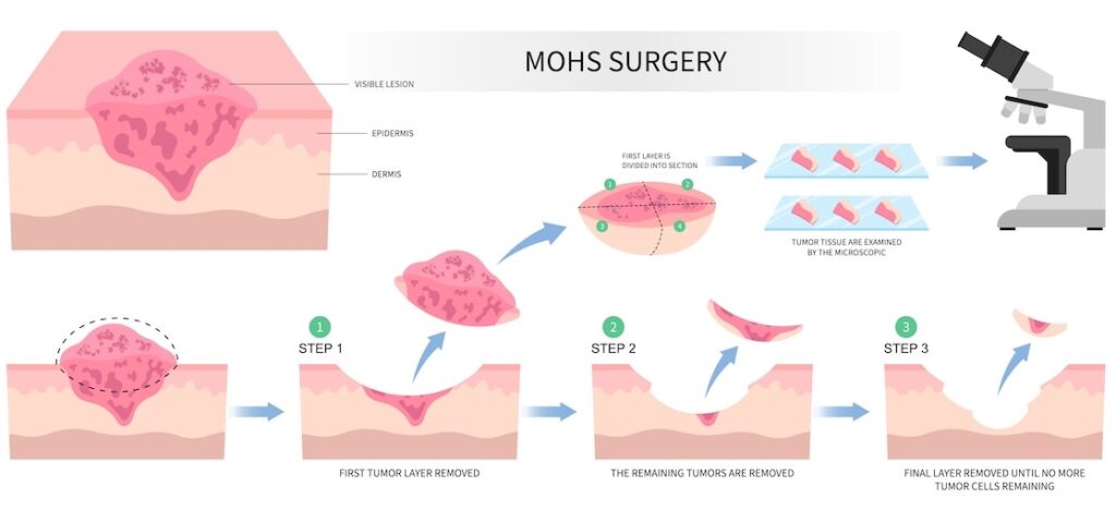 Patient Guide to Mohs Surgery | Knight Dermatology | Orlando, FL
